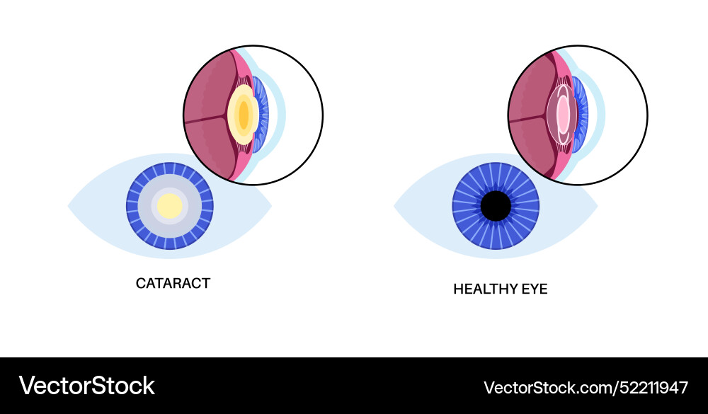 Intraocular lenses poster Royalty Free Vector Image