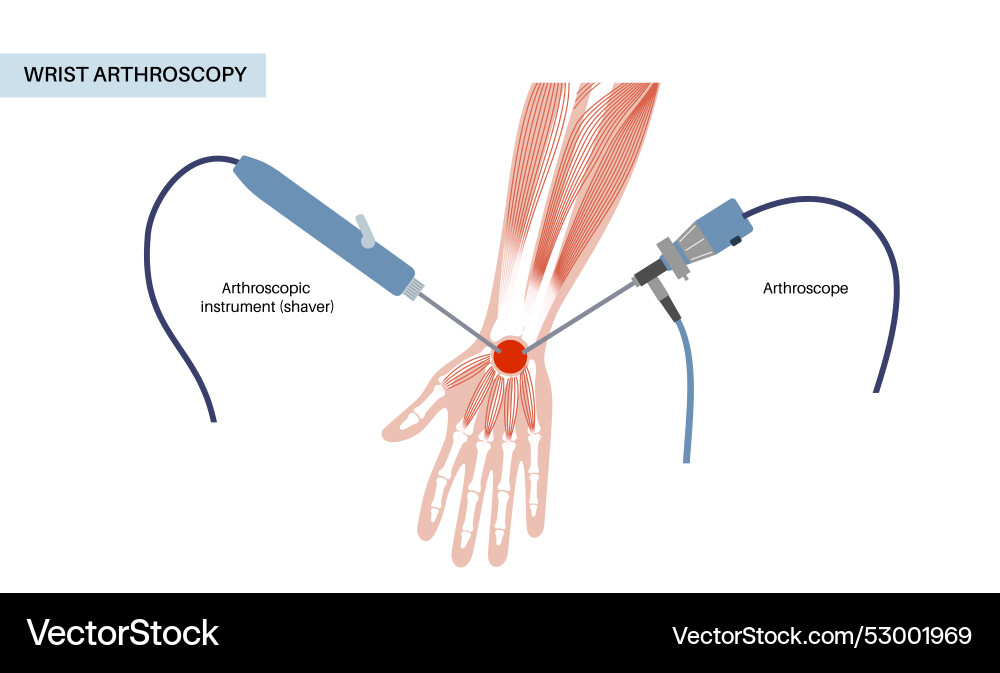 Wrist arthroscopy surgery Royalty Free Vector Image