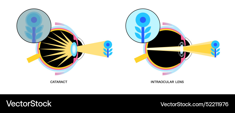 Intraocular lenses poster Royalty Free Vector Image