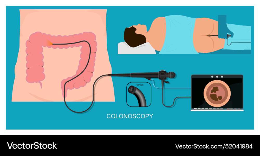 Colonoscopy is an exam used to look for changes Vector Image