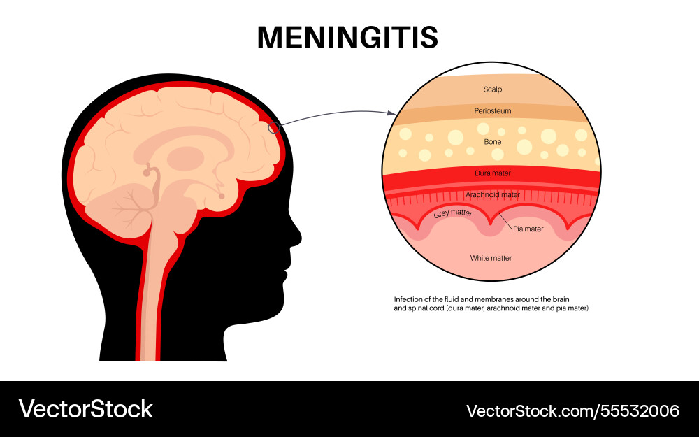 Meningitis medical poster Royalty Free Vector Image