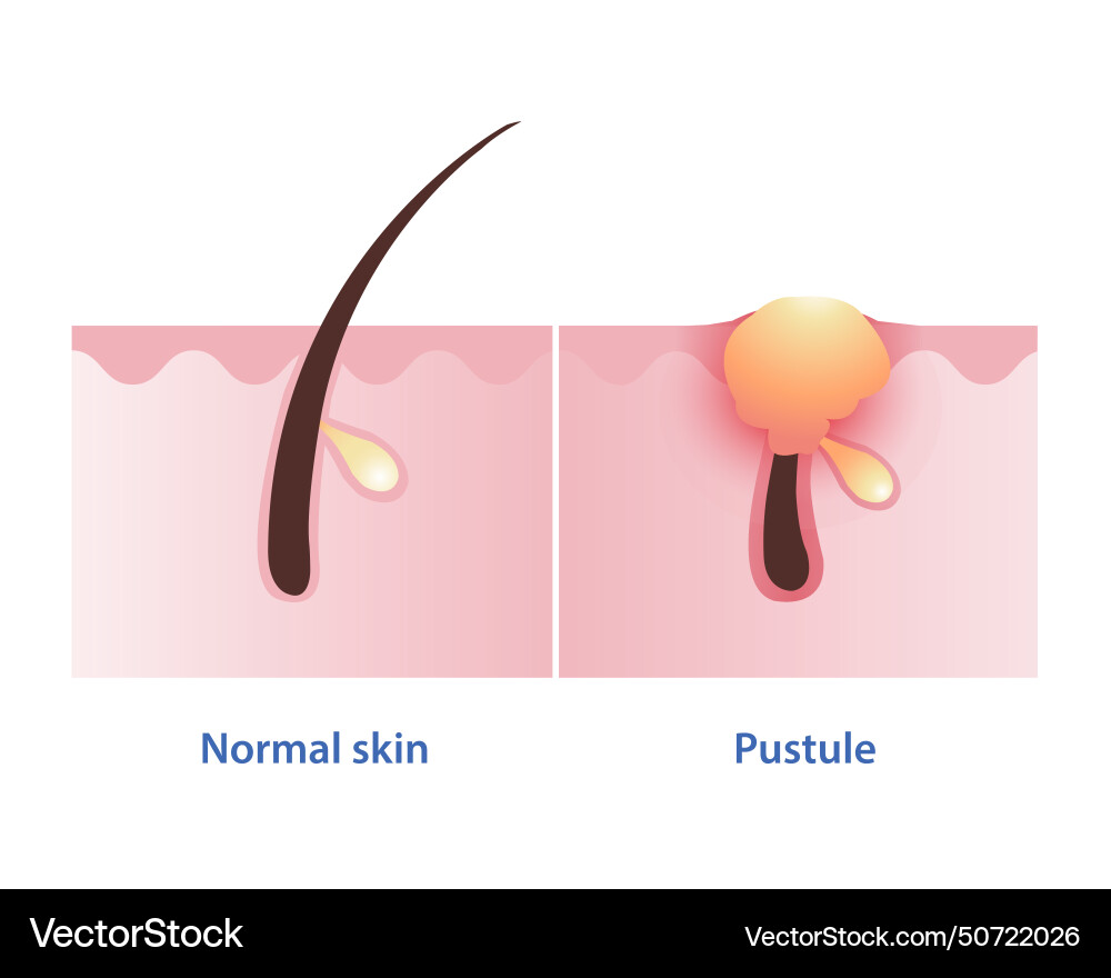 Pustule type of inflammatory acne Royalty Free Vector Image