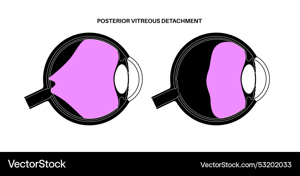 Posterior vitreous detachment Royalty Free Vector Image