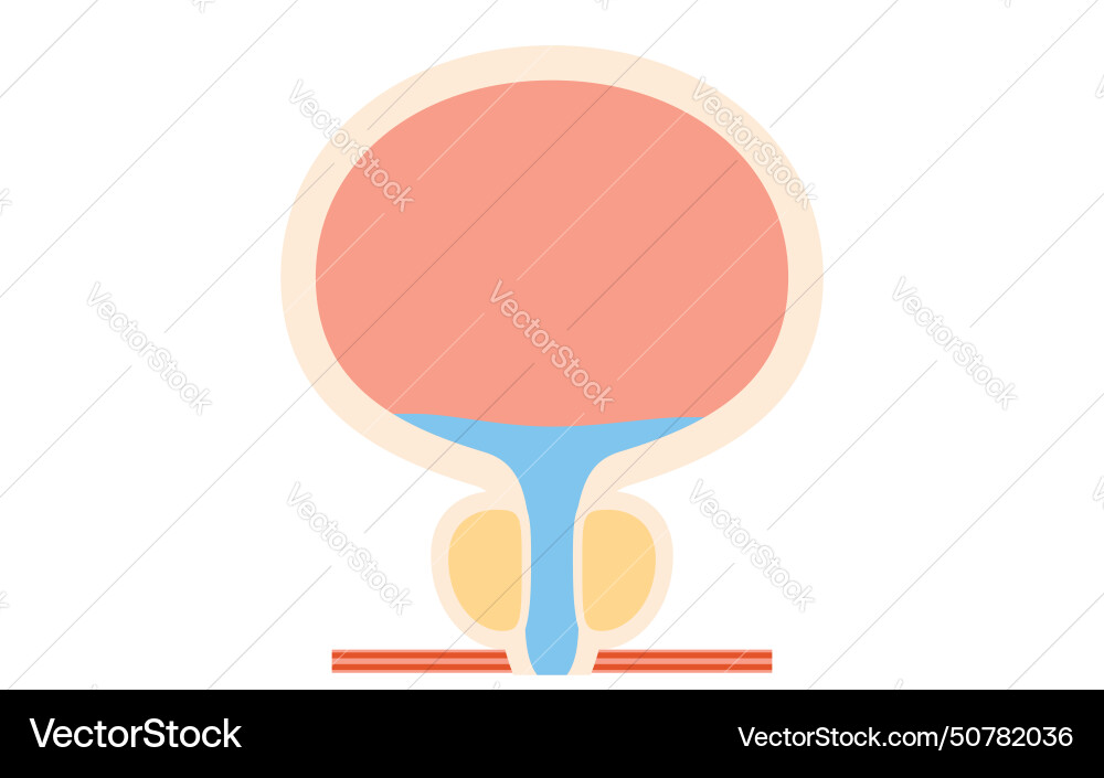 Medical of benign prostatic hyperplasia normal Vector Image