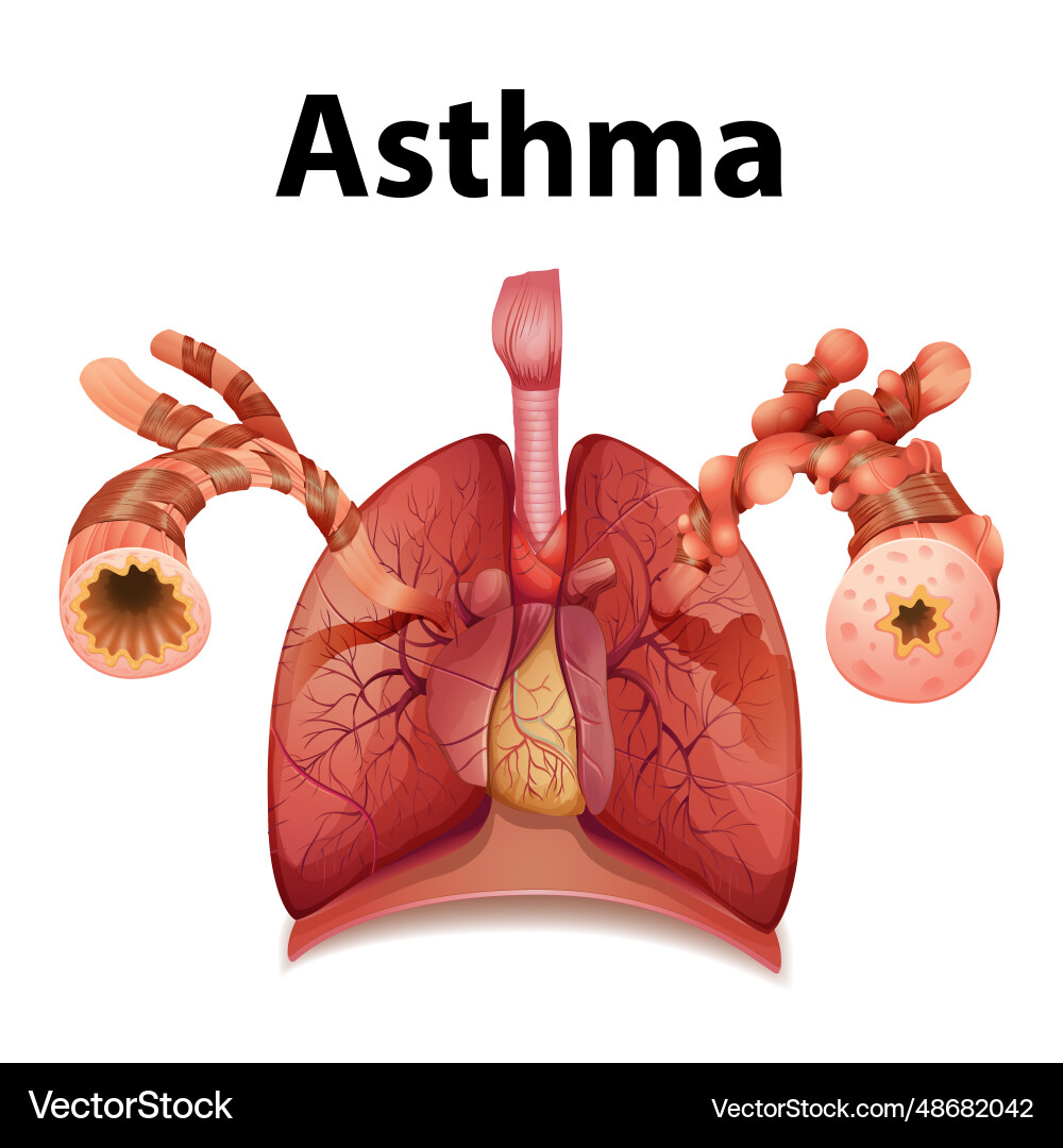 Asthma Lungs Compared To Normal Lungs Bronchiectasis St Vincent's