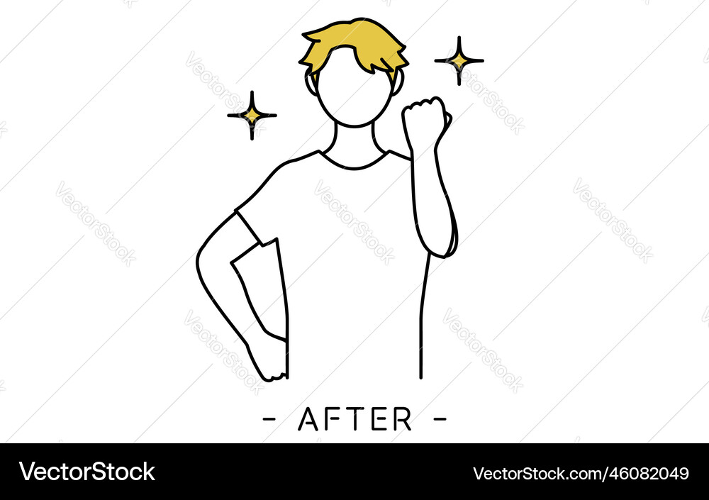 Aga male pattern baldness thinning hair Royalty Free Vector