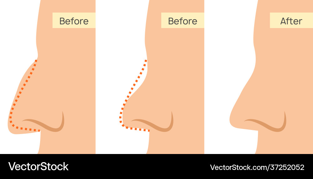 Rhinoplasty nose plastic surgery icon Royalty Free Vector