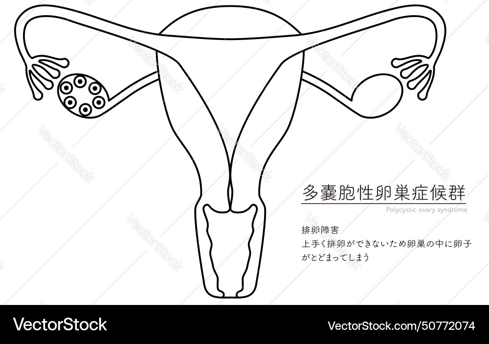 Diagrammatic Of Polycystic Ovary Syndrome Vector Image