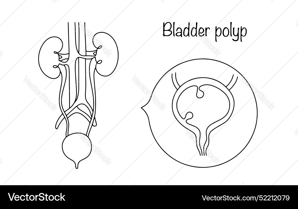 Bladder polyp Royalty Free Vector Image - VectorStock
