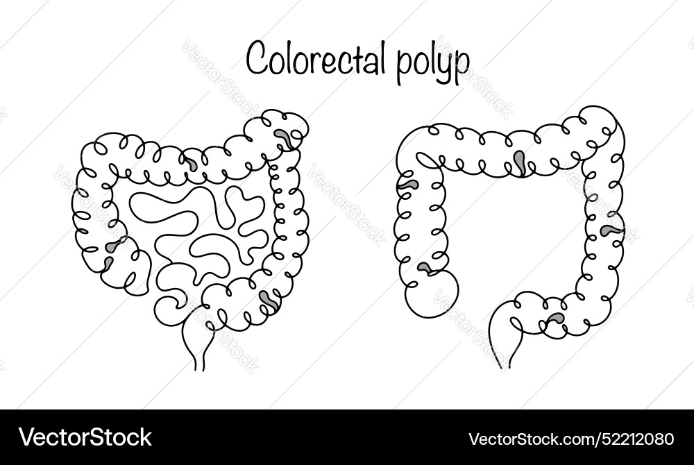 Colorectal polyp Royalty Free Vector Image - VectorStock