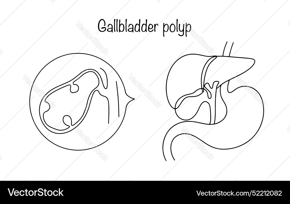 Gallbladder polyp Royalty Free Vector Image - VectorStock