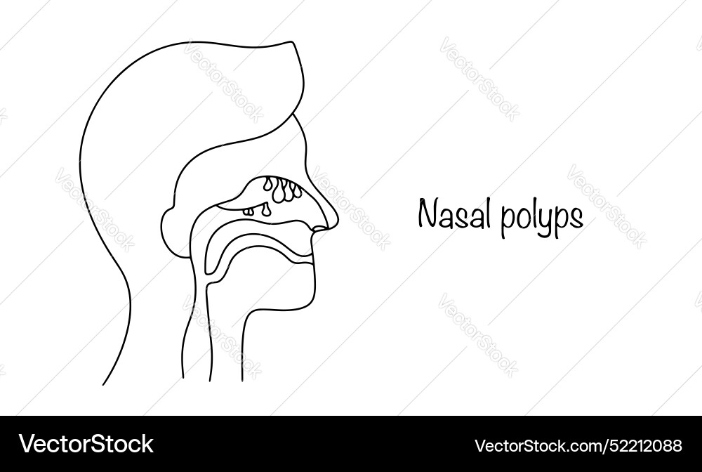 Nasal Polyps Royalty Free Vector Image Vectorstock