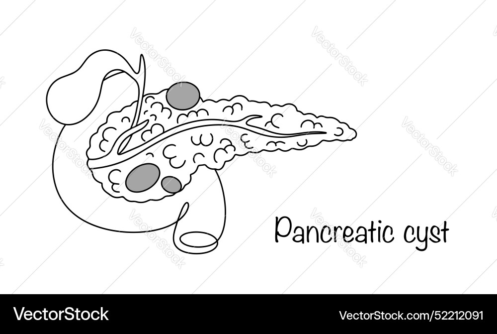 Pancreatic cyst Royalty Free Vector Image - VectorStock