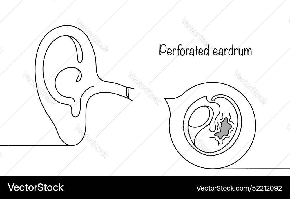 Perforated eardrum Royalty Free Vector Image - VectorStock