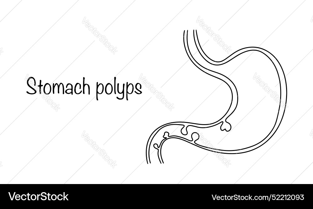 Stomach polyps Royalty Free Vector Image - VectorStock