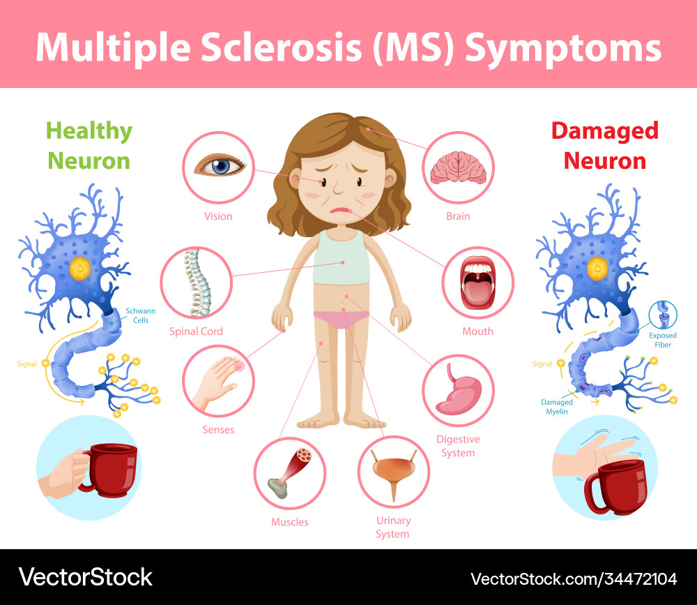 Multiple Sclerosis Symptoms Overview Royalty Free Vector
