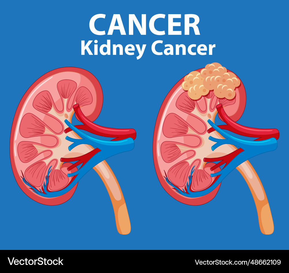 Cancer development process in human kidney Vector Image