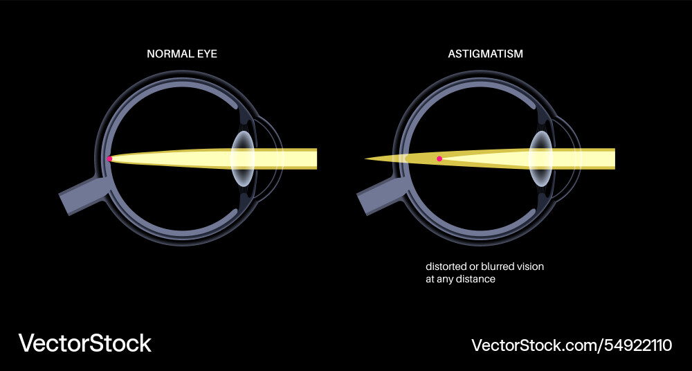 Astigmatism eye disease Royalty Free Vector Image