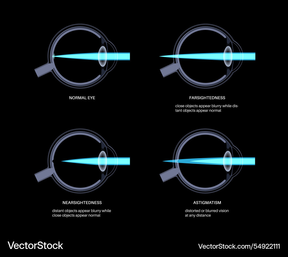 Refractive errors poster Royalty Free Vector Image