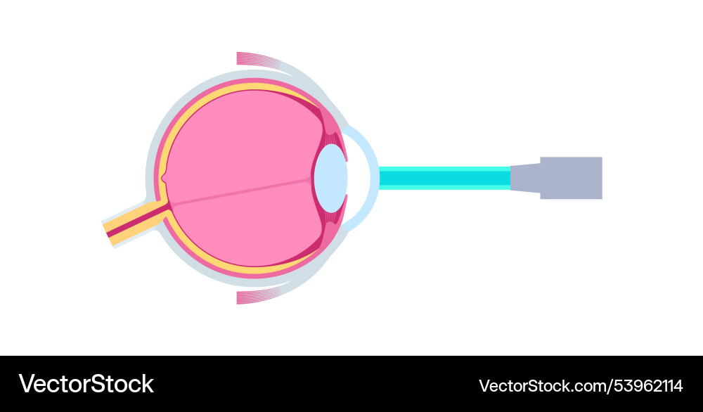 Lasik eye surgery Royalty Free Vector Image - VectorStock