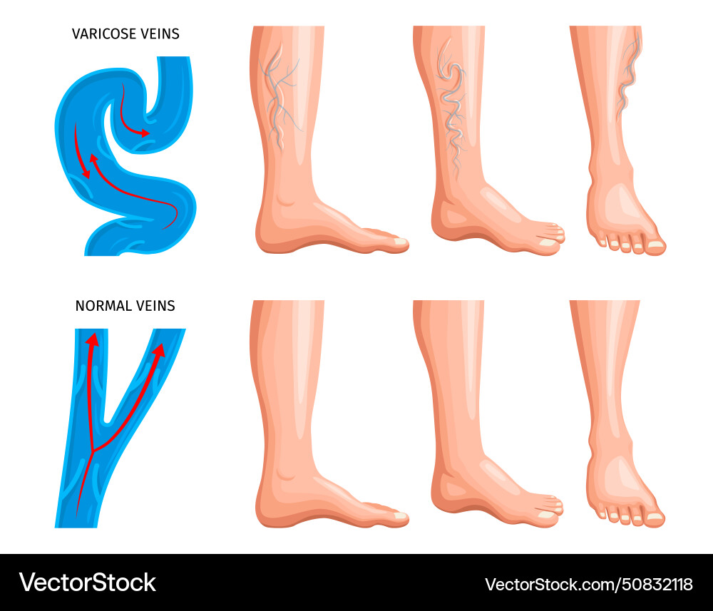Varicose veins anatomy realistic set Royalty Free Vector