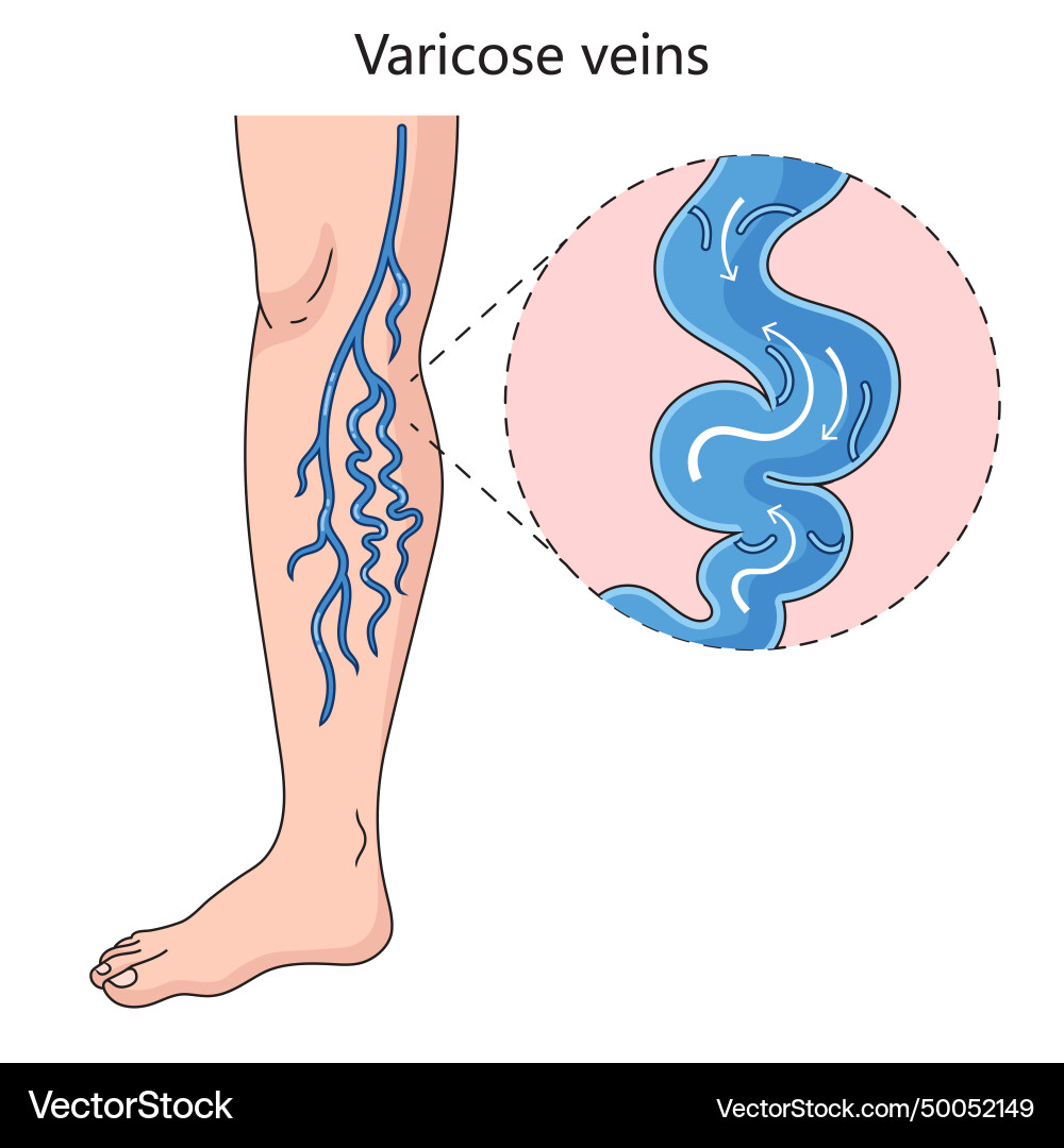 Varicocele Vector Images (20)