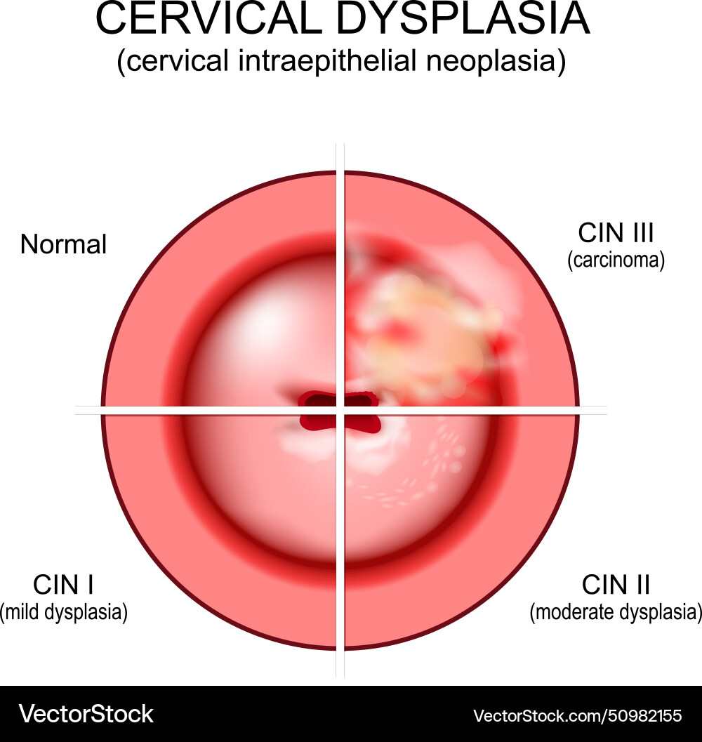Cervical Dysplasia Close Up Of A Cervix Royalty Free Vector