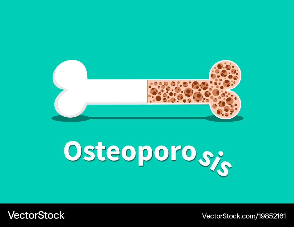 Osteoporosis bone structure in design Royalty Free Vector
