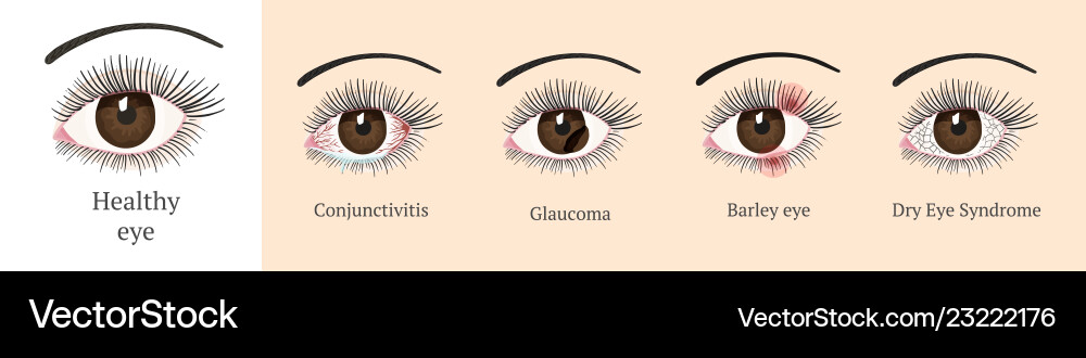 Most common eye problems Royalty Free Vector Image