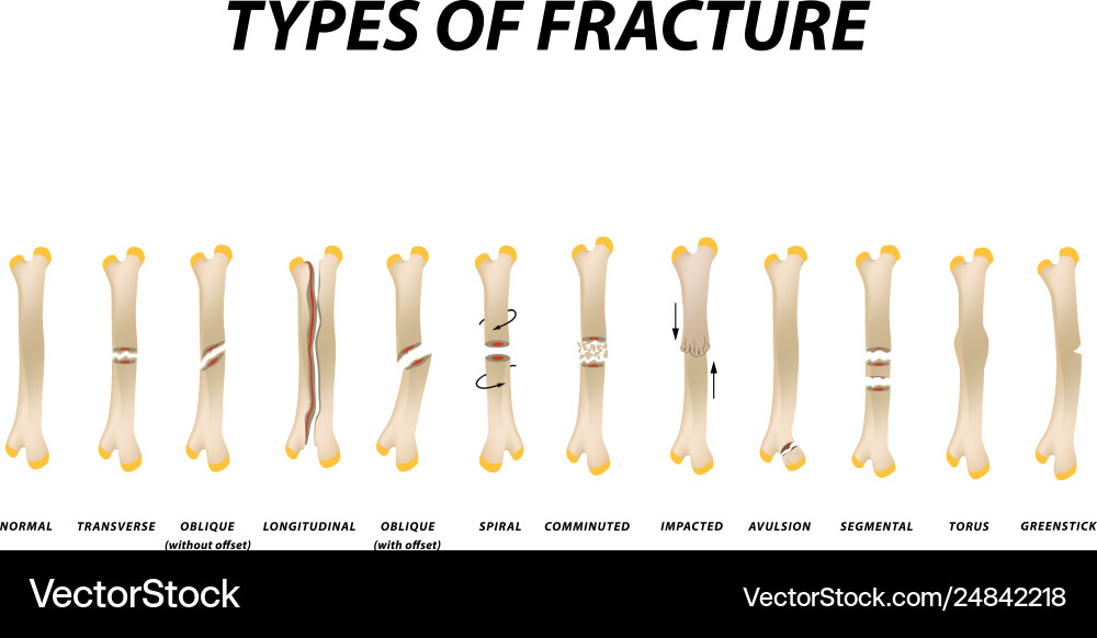 Types fracture bone set infographics Royalty Free Vector