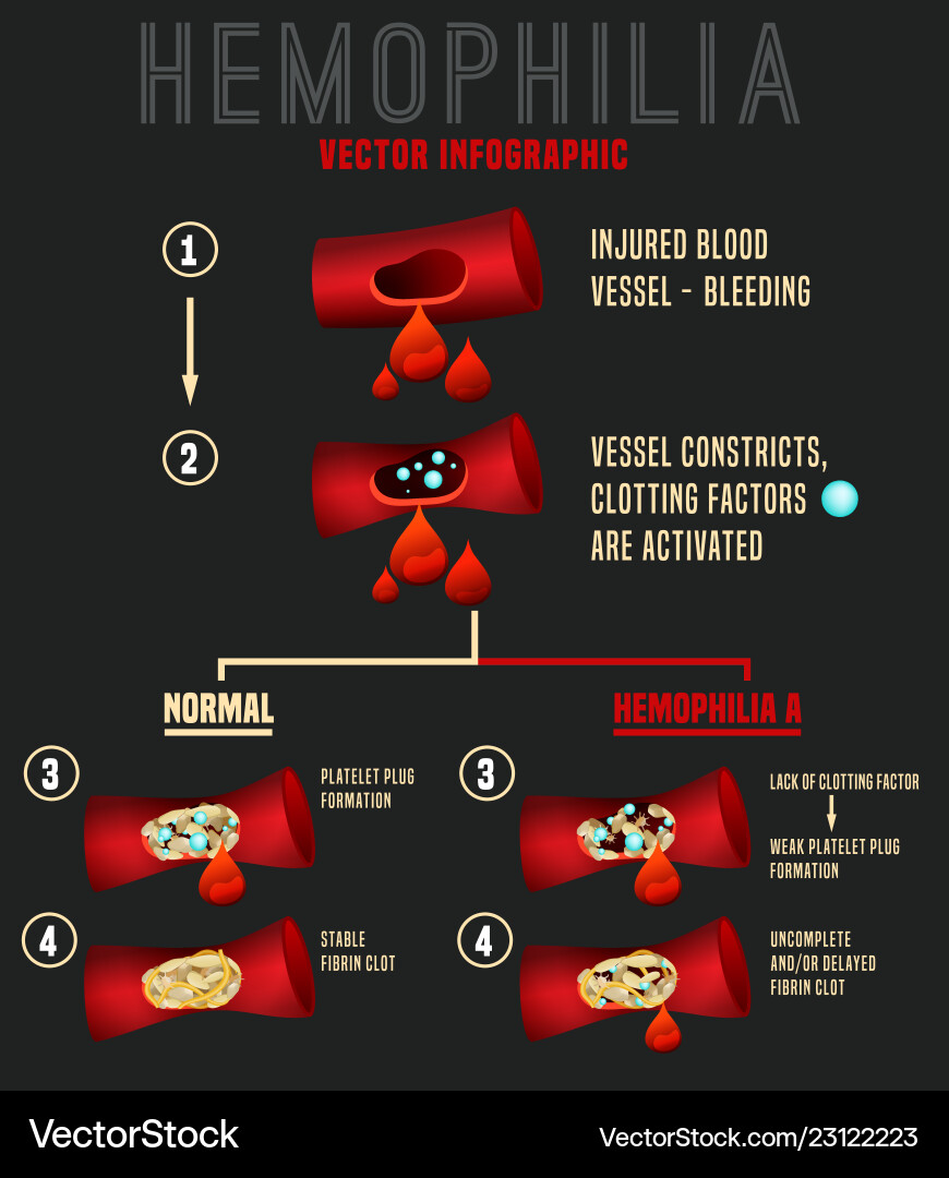 Hemophilia infographics image Royalty Free Vector Image