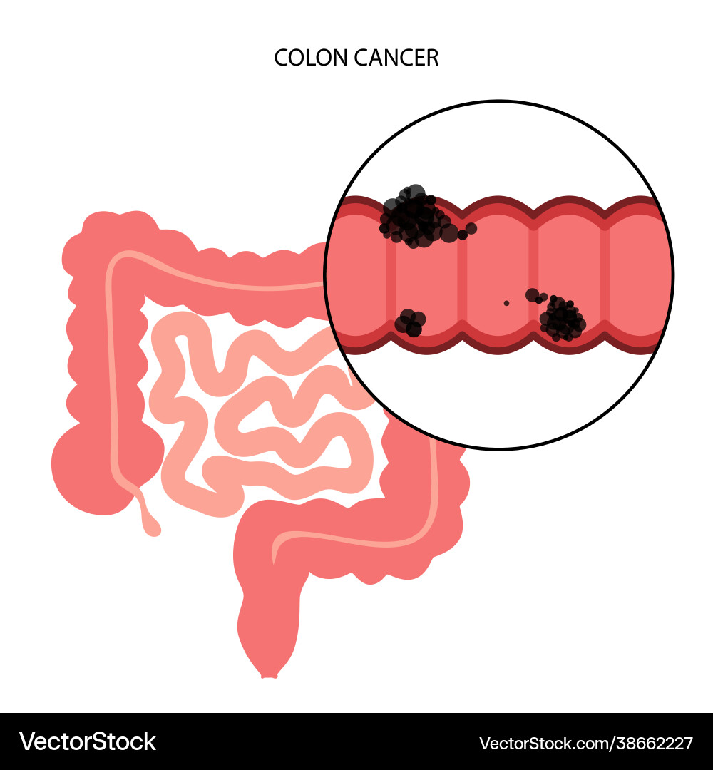 Colon cancer stage Royalty Free Vector Image - VectorStock