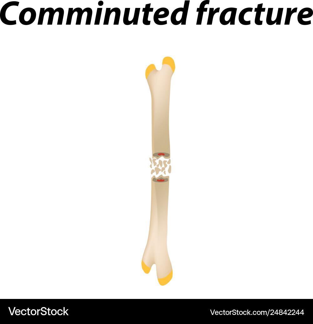 Comminuted fracture bone infographics Royalty Free Vector