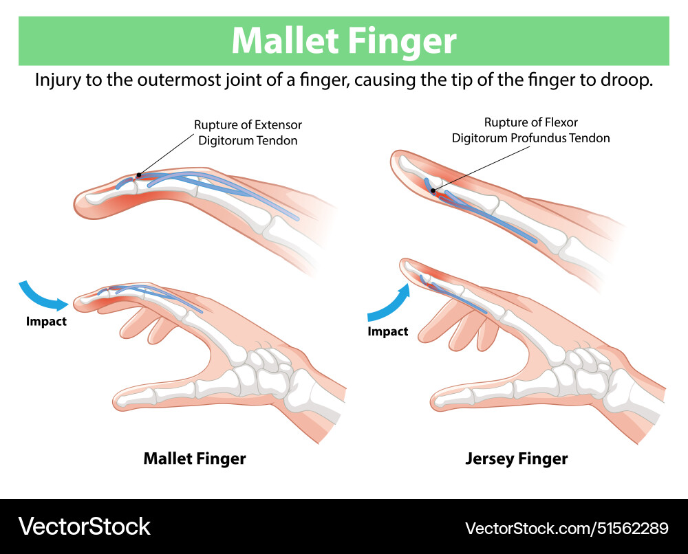 Finger tendon injuries and their impacts Vector Image