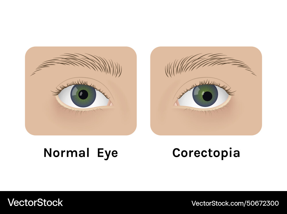 Realistic human normal eyes and with corectopia Vector Image