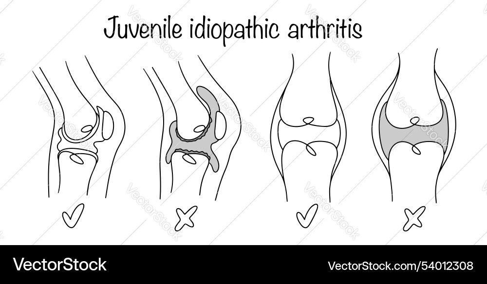 Juvenile idiopathic arthritis Royalty Free Vector Image