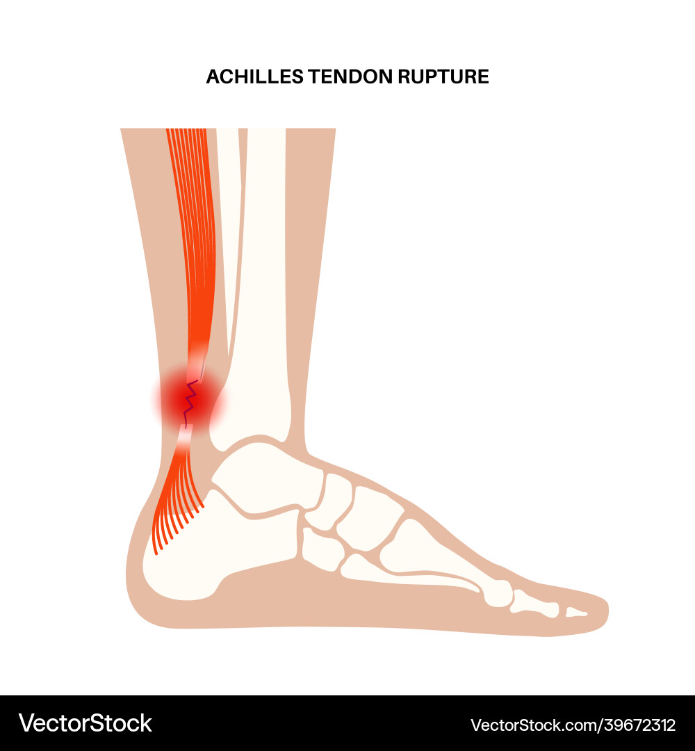 Achilles Tendon Rupture Anatomy Royalty Free Vector Image