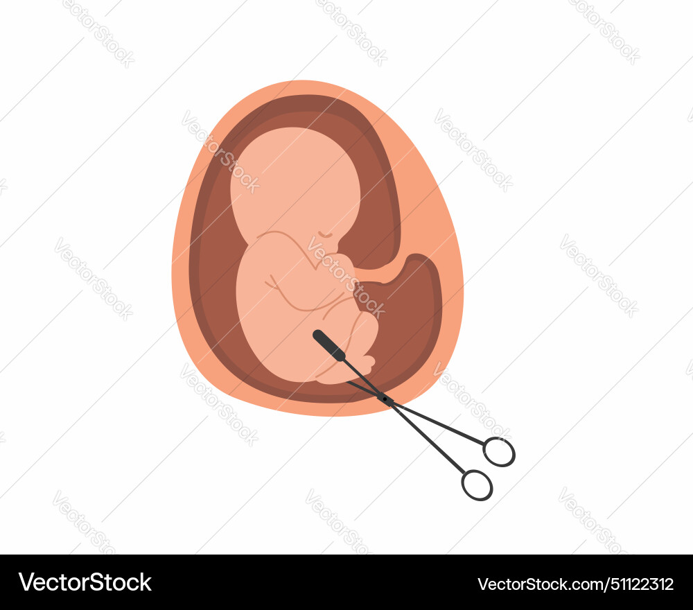 Embryo with surgical forcep stop abortion campaign