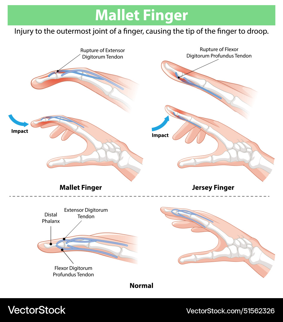 Diagram showing mallet and jersey finger injuries Vector Image