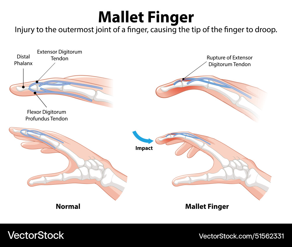 Diagram showing normal and mallet finger Vector Image