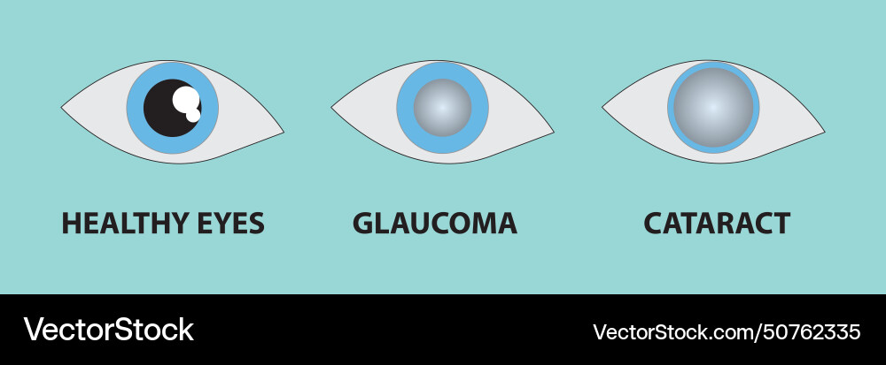 A healthy eye glaucoma cataract Royalty Free Vector Image