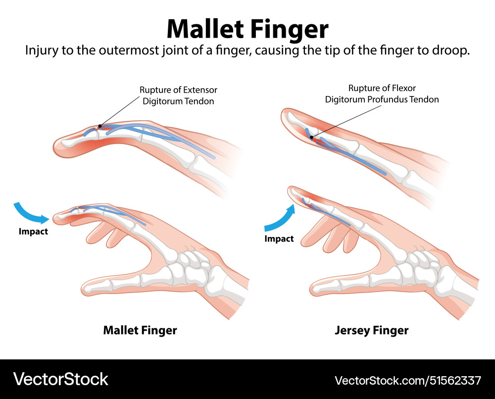 Finger tendon injuries and impacts Royalty Free Vector Image