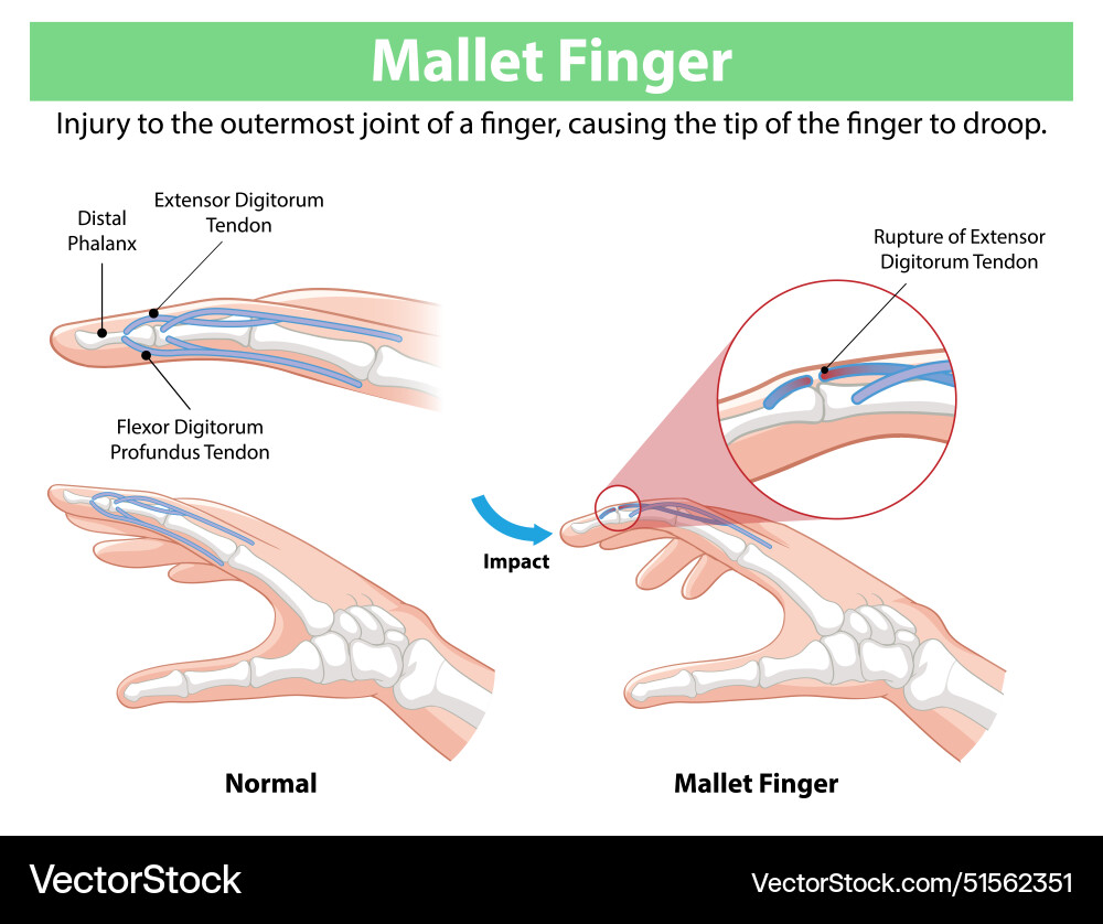 Diagram showing normal and mallet finger Vector Image