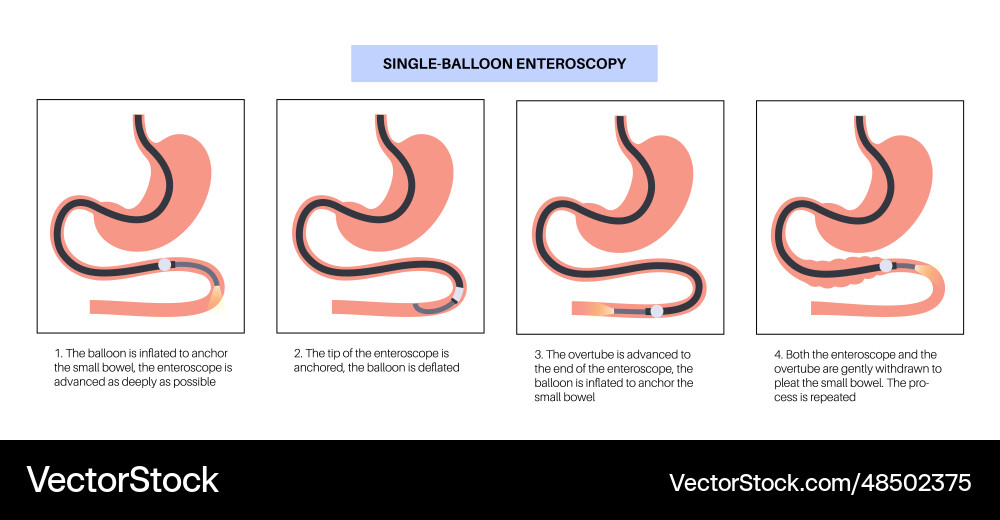 Single balloon enteroscopy Royalty Free Vector Image
