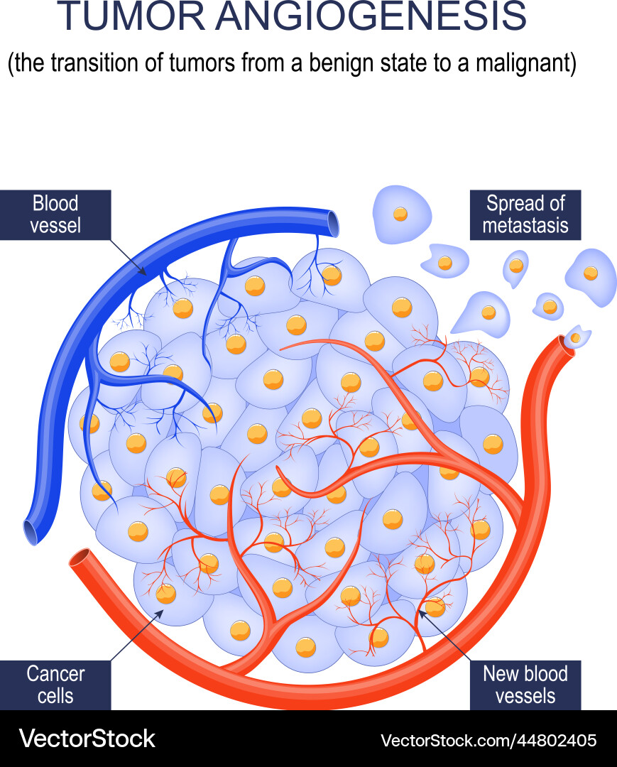 Tumor Angiogenesis: Cancer Growth Royalty Free Vector Image
