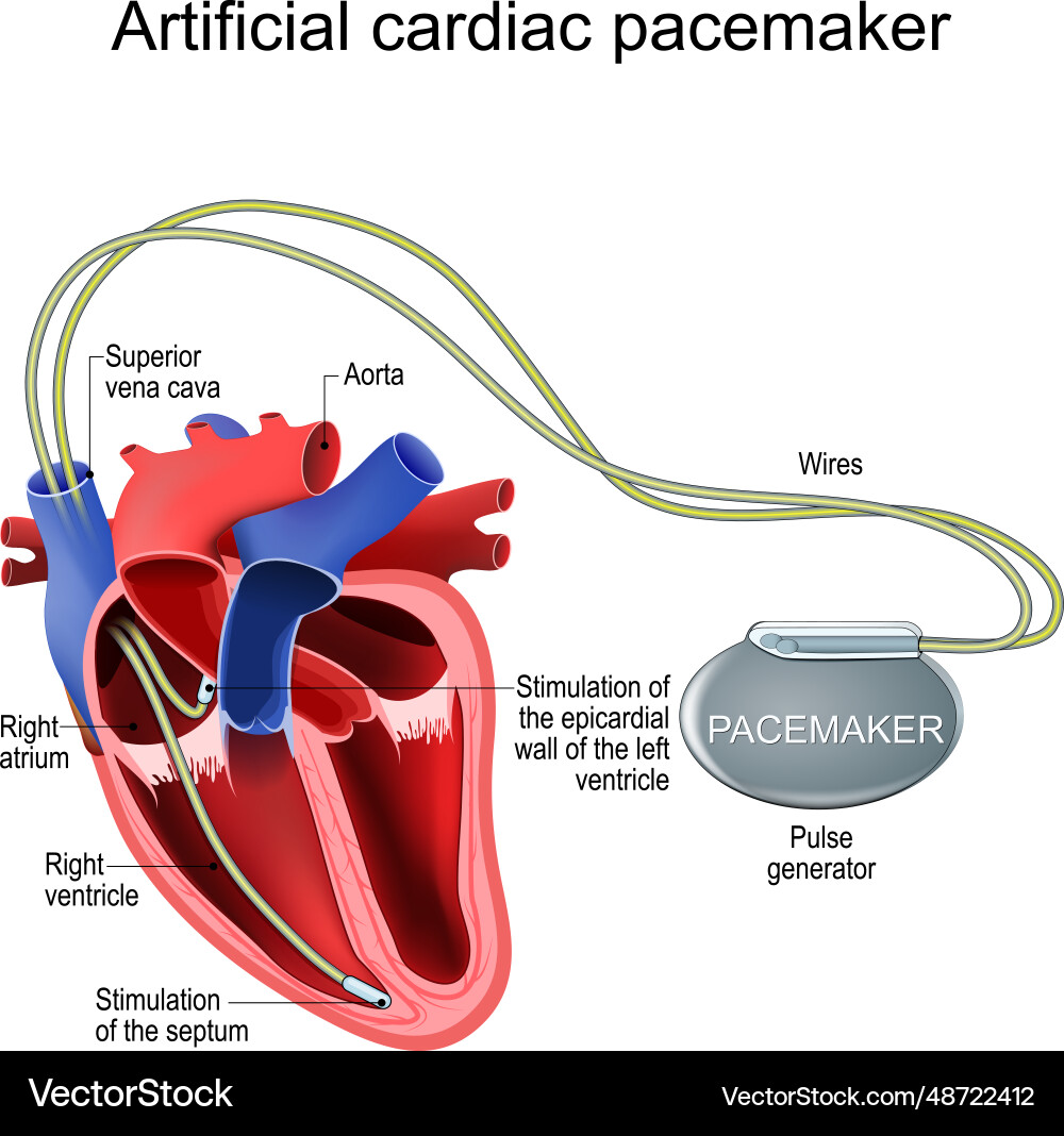 Artificial cardiac pacemaker heart implant Vector Image