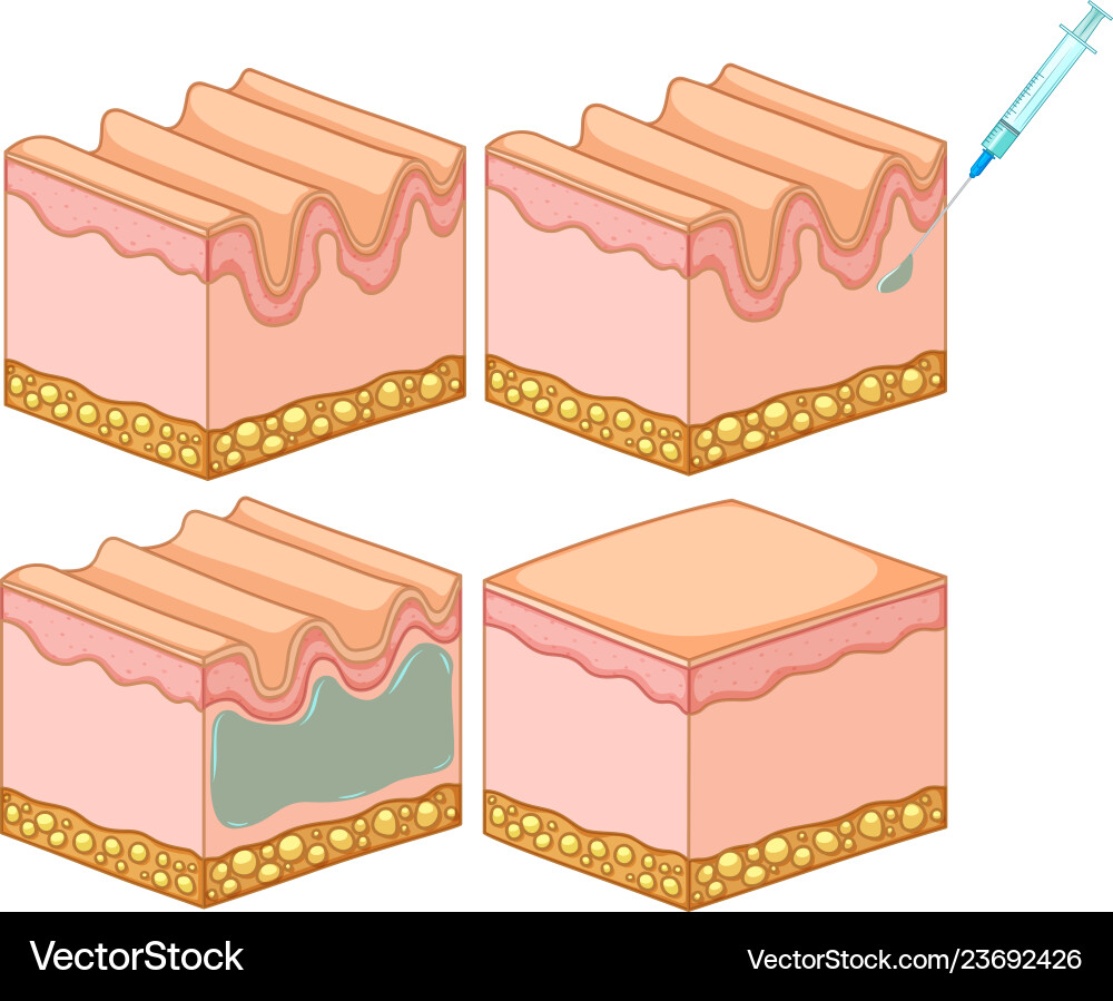 Botox Syringe Vector Images (over 450)