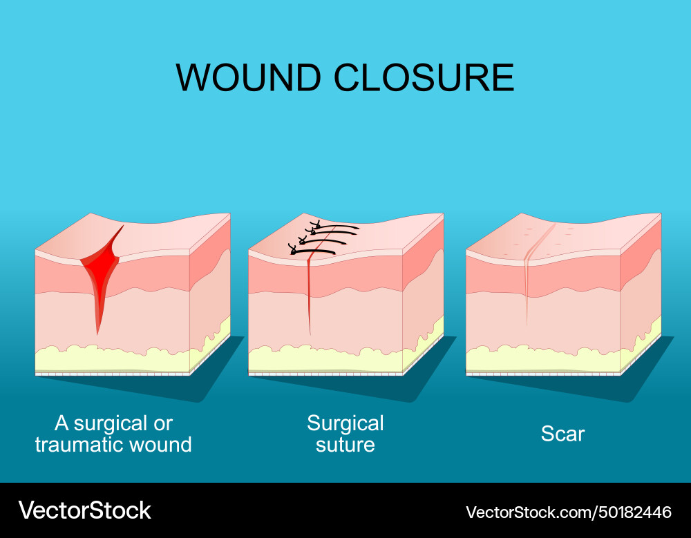 Wound healing Royalty Free Vector Image - VectorStock