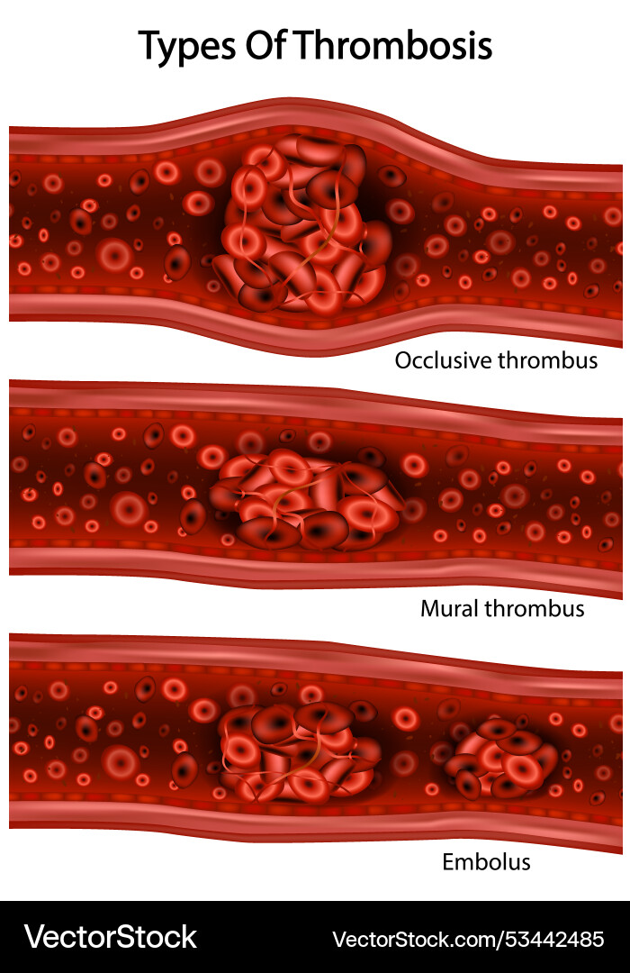 Embolus occlusive thrombus mural types Royalty Free Vector