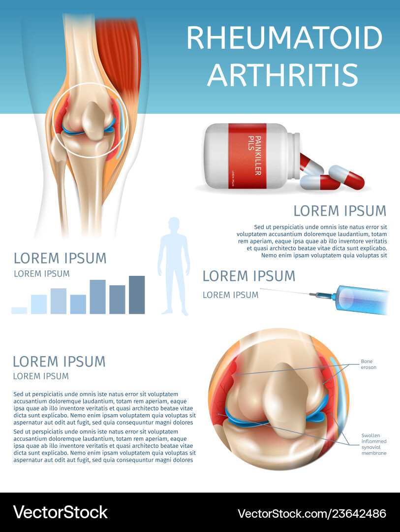 Infographic treatment method rheumatoid arthritis Vector Image